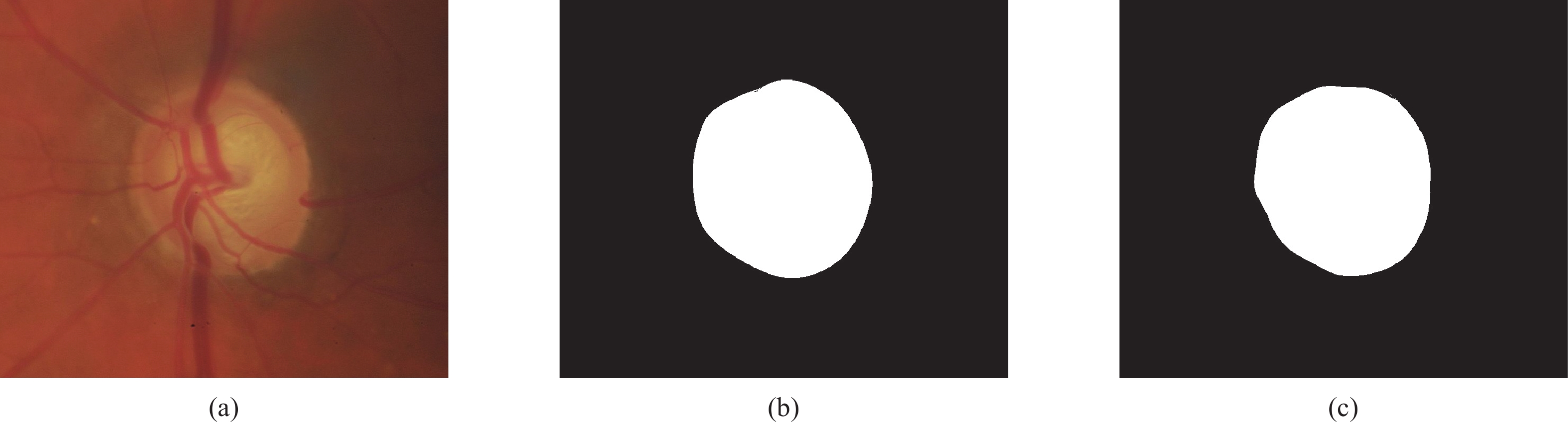 Glaucoma Detection with Retinal Fundus Images Using Segmentation and Classification